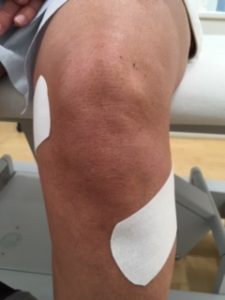 Genu recurvatum: técnica de corrección mecánica. - Kinesiology Tape