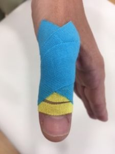 Capsulitis interfalángica distal del primer dedo: variante con técnica ...